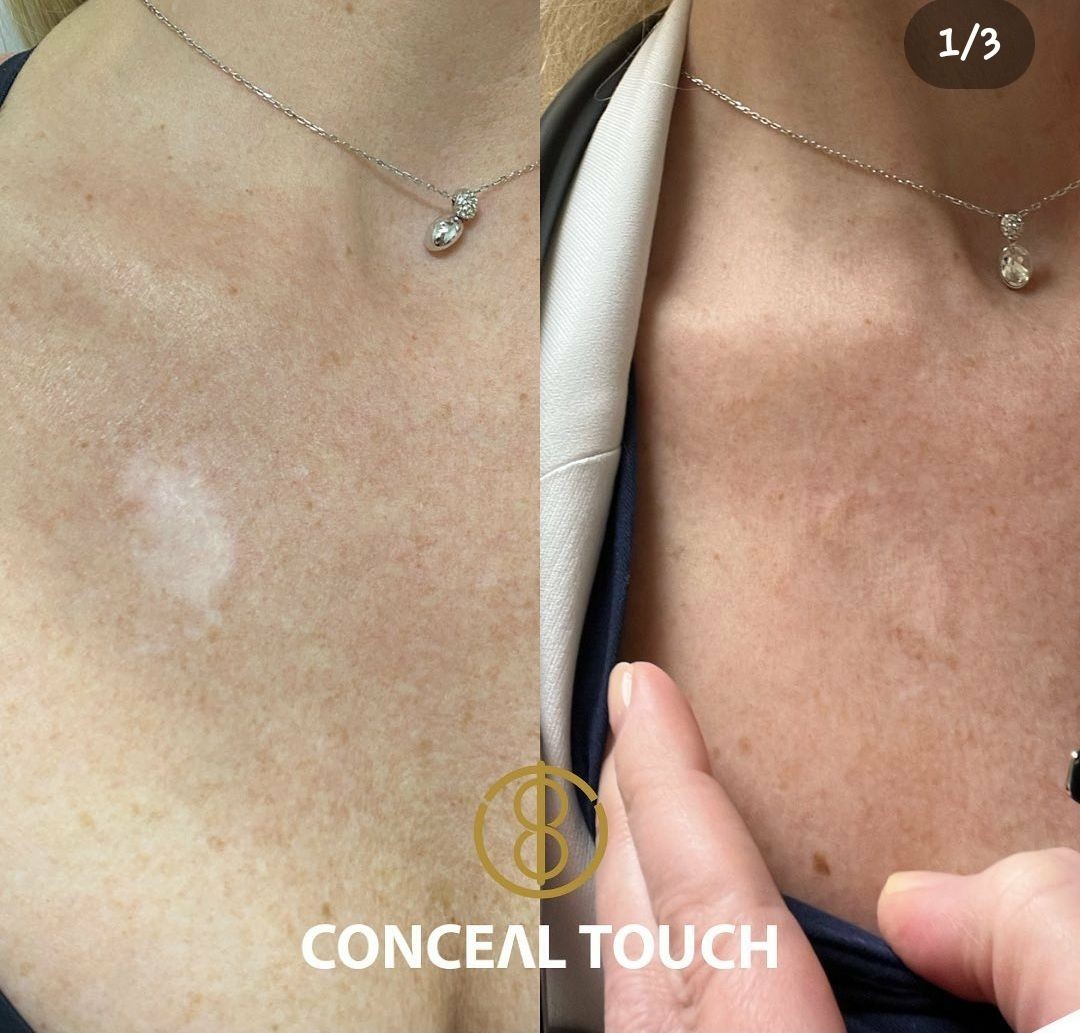 Scar treatment product.