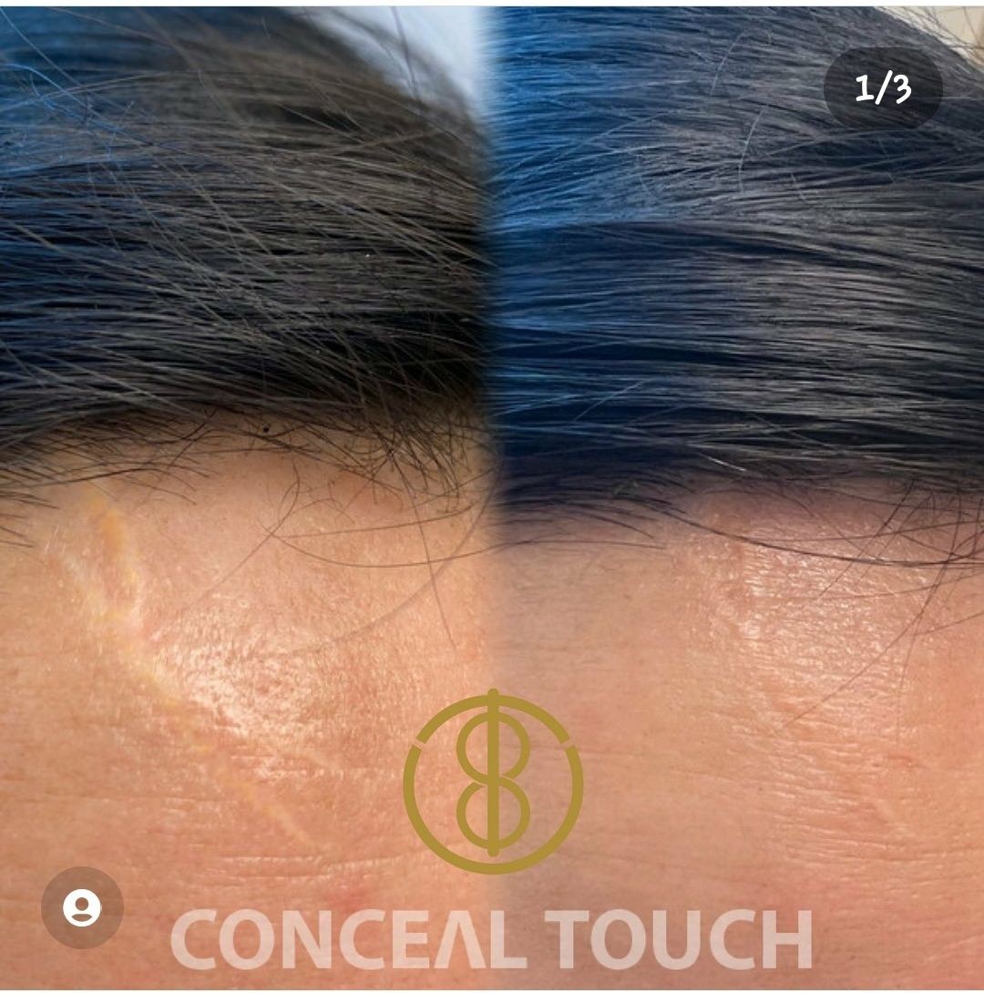 Scar treatment product.